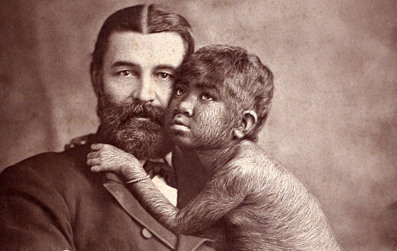 17 babies in Spain develop 'werewolf syndrome' after drugs mix-up - The ...